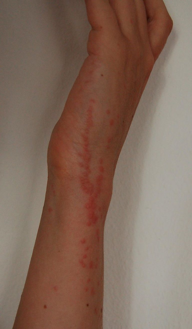 Bed Bug Bites - Symptoms and Treatments - The Pest Advice